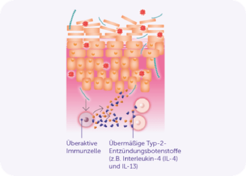 Neurodermitis Ursachen
